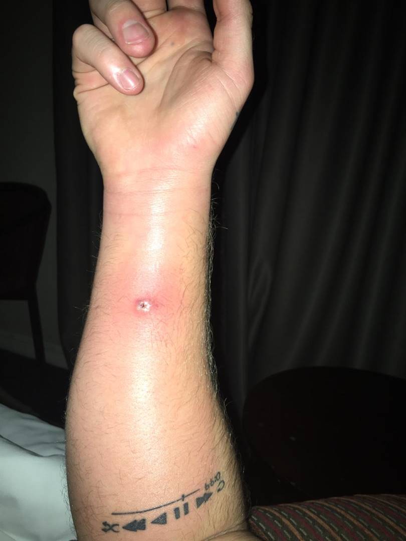 Rugbyspeler van kwarantyn na hospitaal oor bytplek | Netwerk24