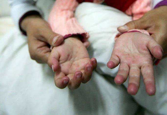 IVP eis dringende ingryping oor hand-voet-en-mond-siekte | Netwerk24