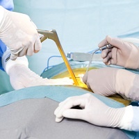 Laminectomy | News24