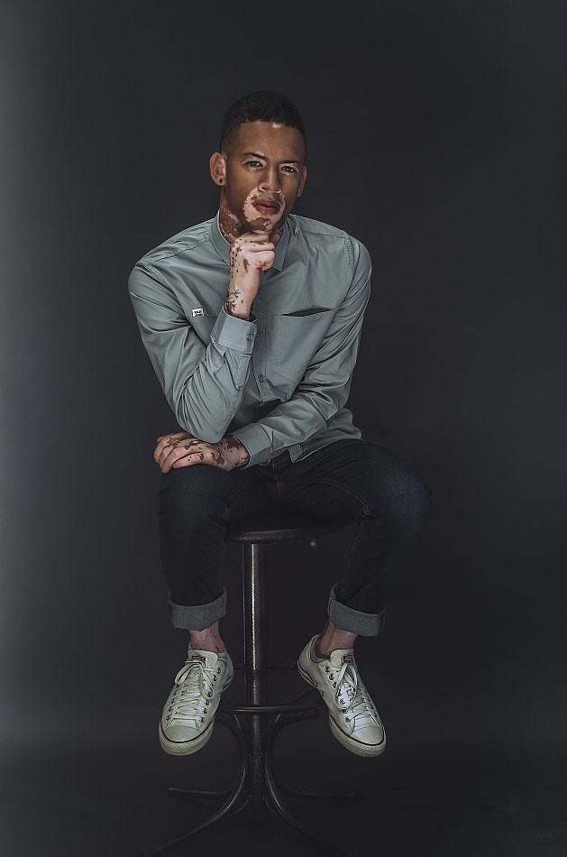 Vitiligo: Eers was dit hel met vlekke op sy vel, nou wil hy Mnr. SA ...